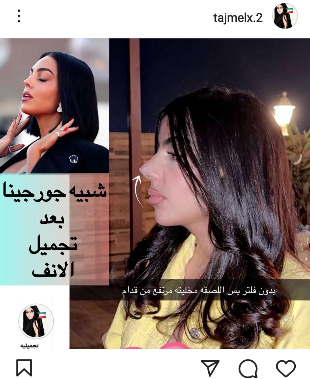 شبيهة جورجينا ريما العنزي تفاجئ متابعيها بعملية تجميل جديدة شاهد كيف ظهرت